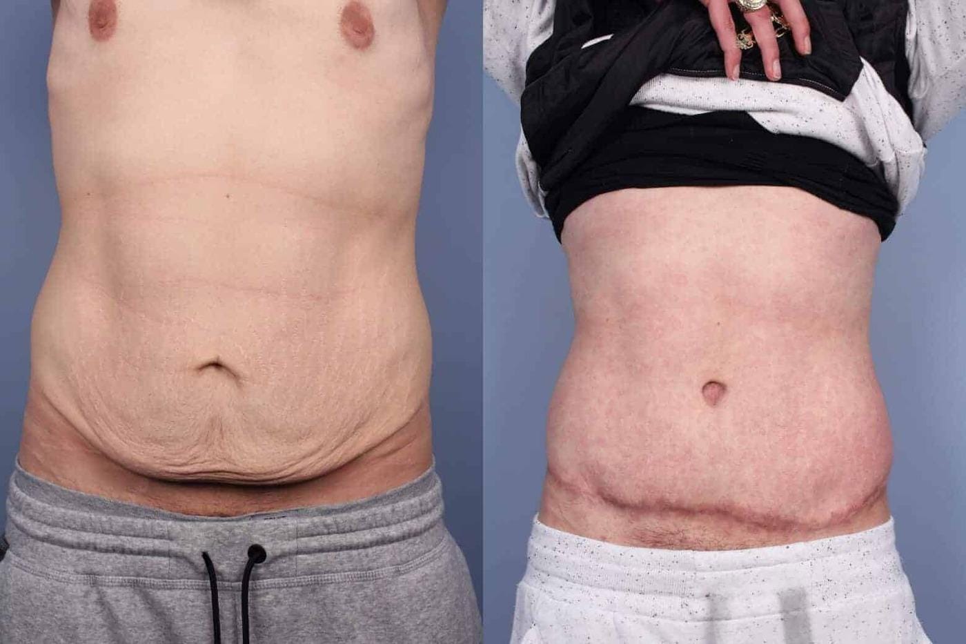 Before And After Mini Tummy Tuck Recovery Heavyfas