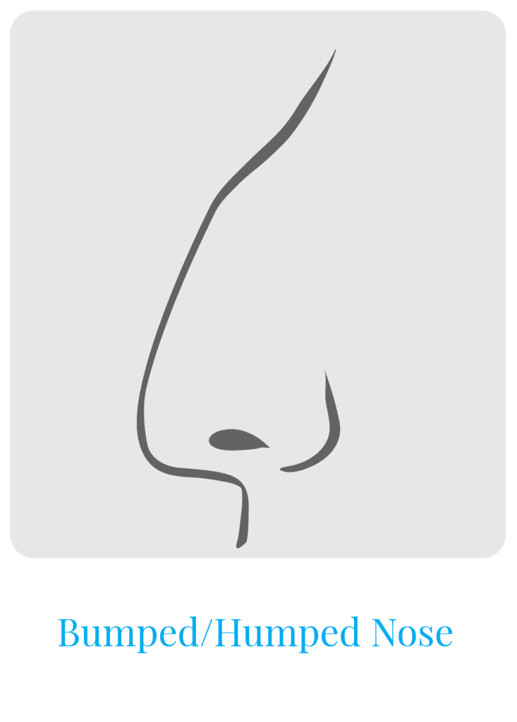Most Common & Desired Nose Shapes | Toronto Plastic Surgeon Wellness Centre