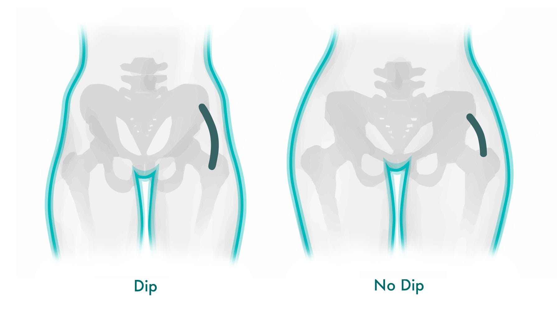 Hip Dip Good Or Bad